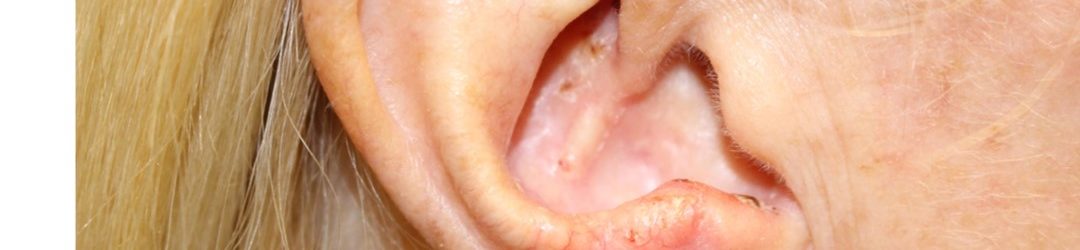 Introduction to Skin Cancer - For Patients - American Head & Neck Society