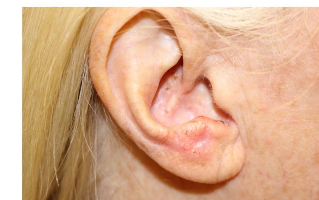 Introduction to Skin Cancer - For Patients - American Head & Neck Society