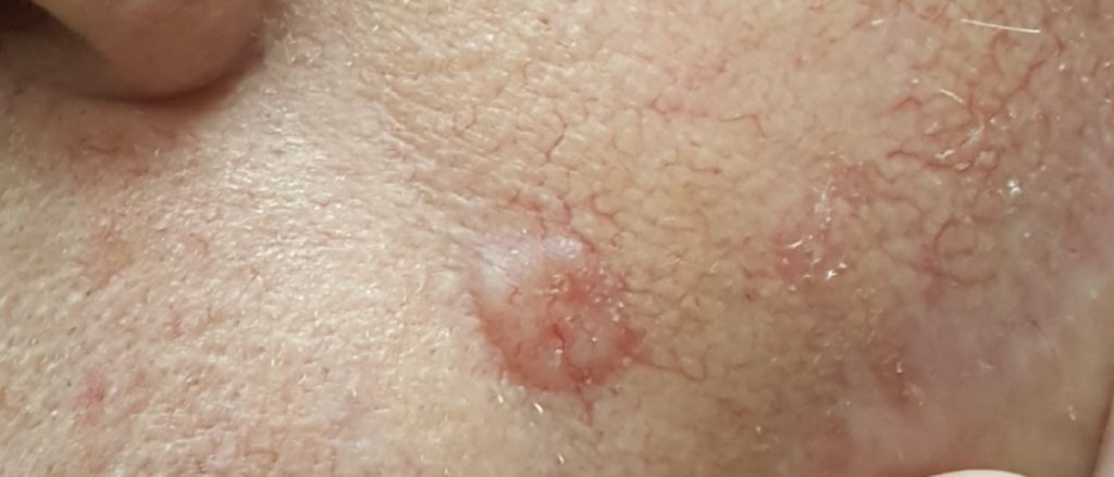 Introduction to Skin Cancer - For Patients - American Head & Neck Society