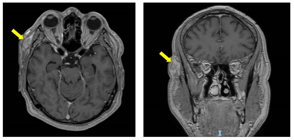Cutaneous Malignancies in the Organ Transplant Population - American ...