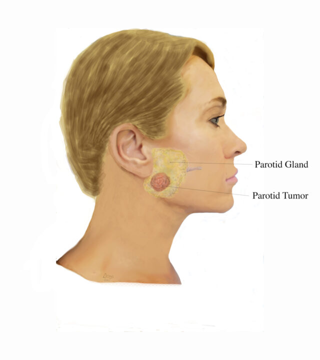 What is the parotid? Why do I need a parotidectomy? - American Head ...