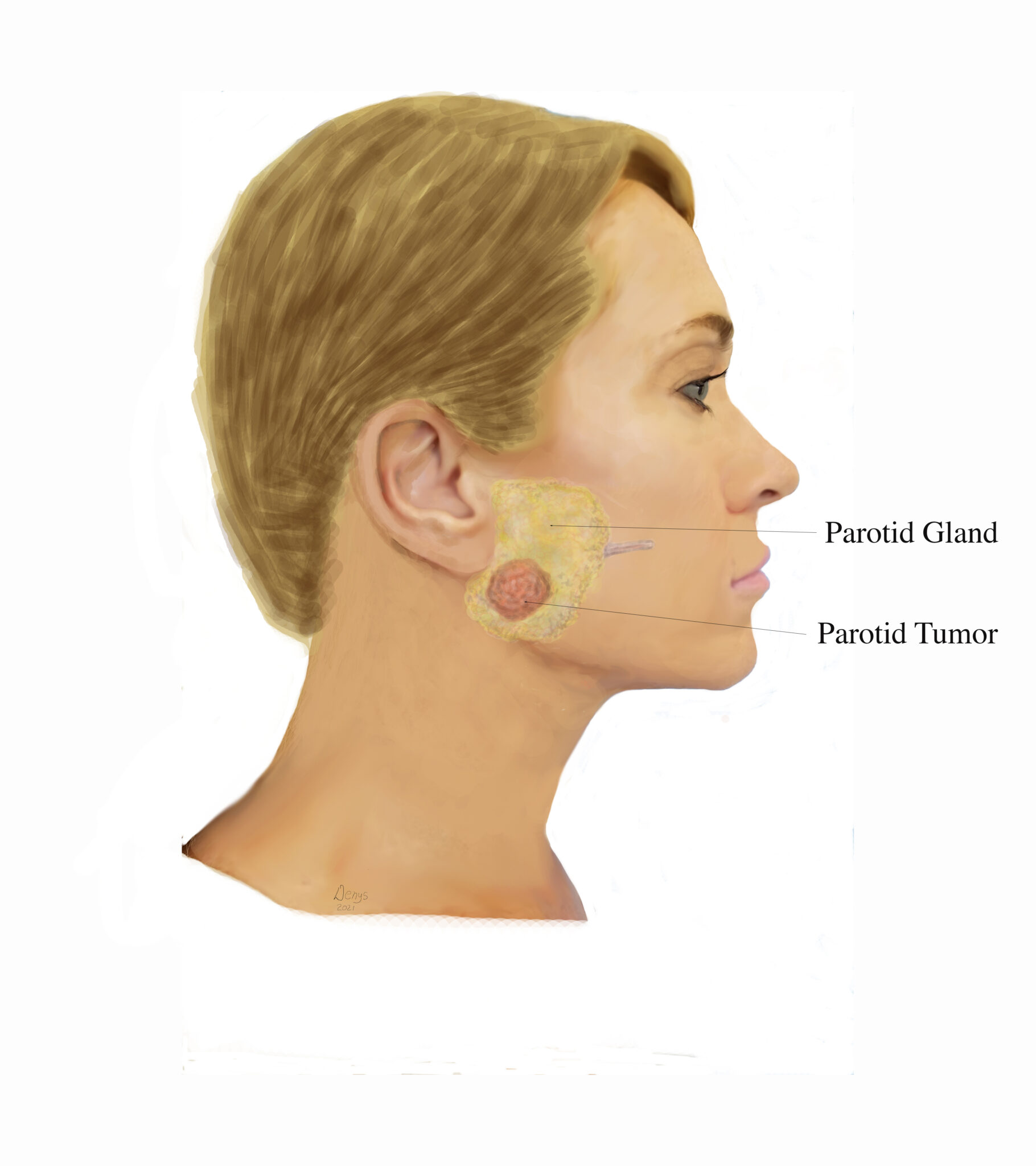 What is the parotid? Why do I need a parotidectomy? - American Head ...
